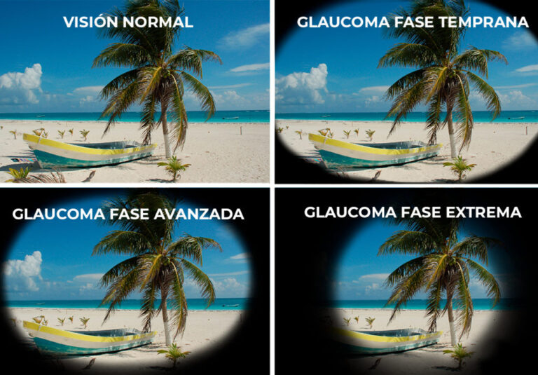 GLAUCOMA – MIRA
